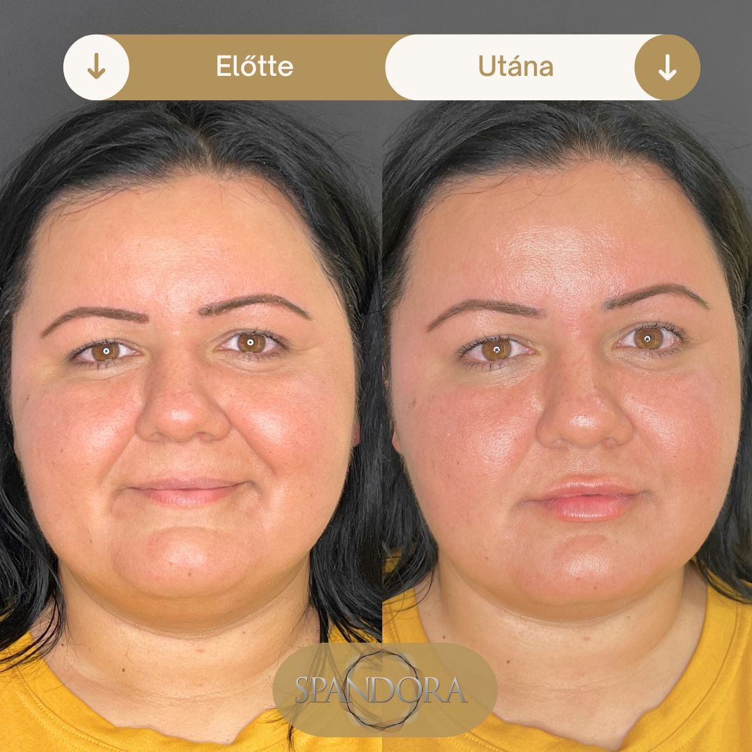 Marionett ránc, Nasolabialis redő - Spandora Esztétikai Központ Budapest